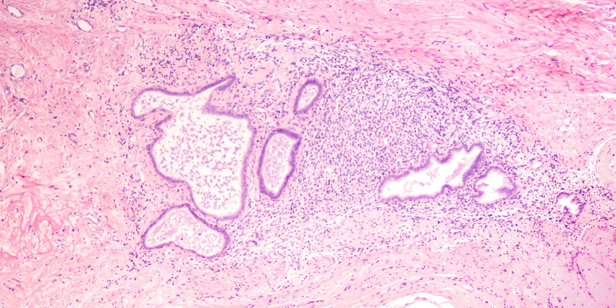 MAPIRANJE ENDOMETRIOZE: stvara se golemi stanični atlas | vasezdravlje.com