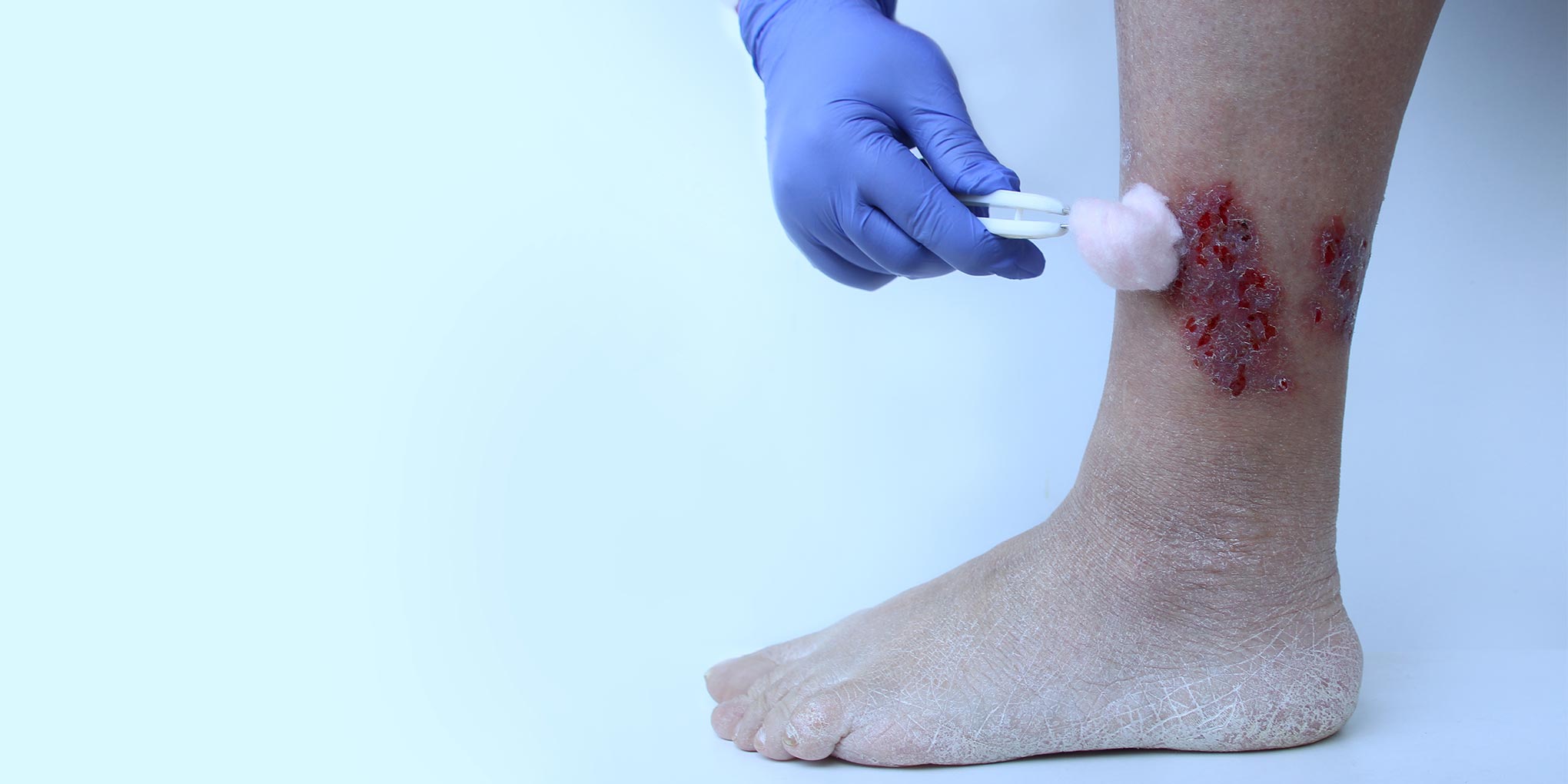 Dekubitus - rana koja ne zacjeljuje | vasezdravlje.com