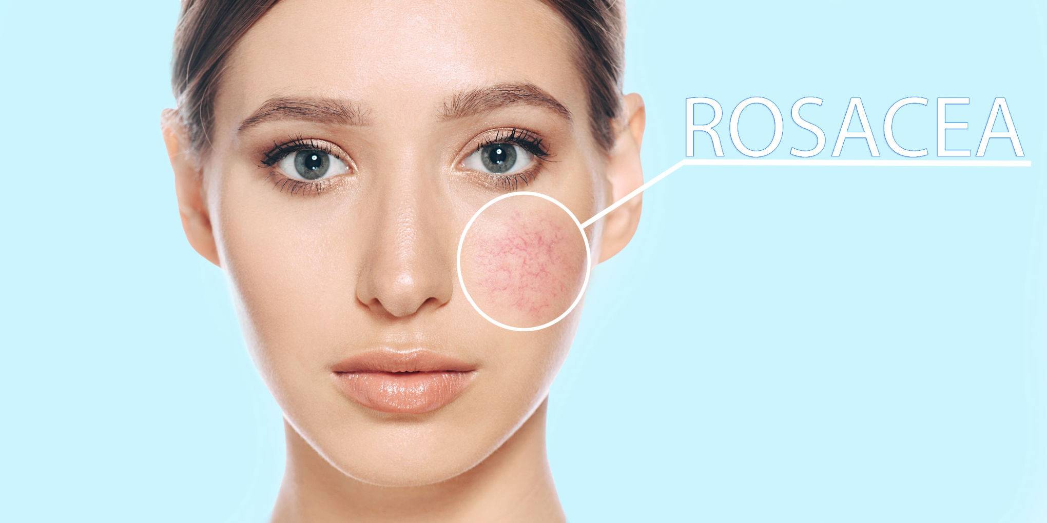Rozaceja, kuperoza - bolest iskrivljenih predodžbi | vasezdravlje.com