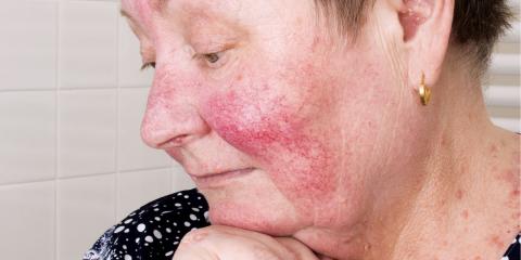 Rozaceja, kuperoza - sumnjivo crvenilo lica | vasezdravlje.com