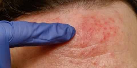 Svrab (šuga) - uzrok, simptomi i liječenje | vasezdravlje.com