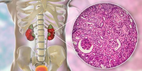 Akutna upala bubrega (akutni pijelonefritis) | vasezdravlje.com